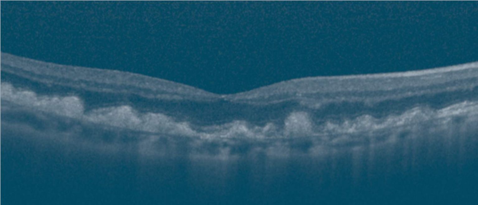 Dry AMD and Geographic Atrophy 2023